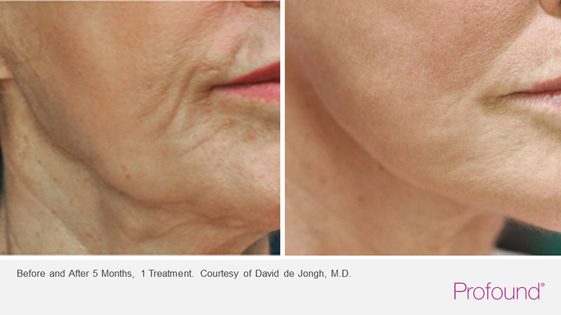 Profound Facial Treatment Before & After Arlington, DC Metro