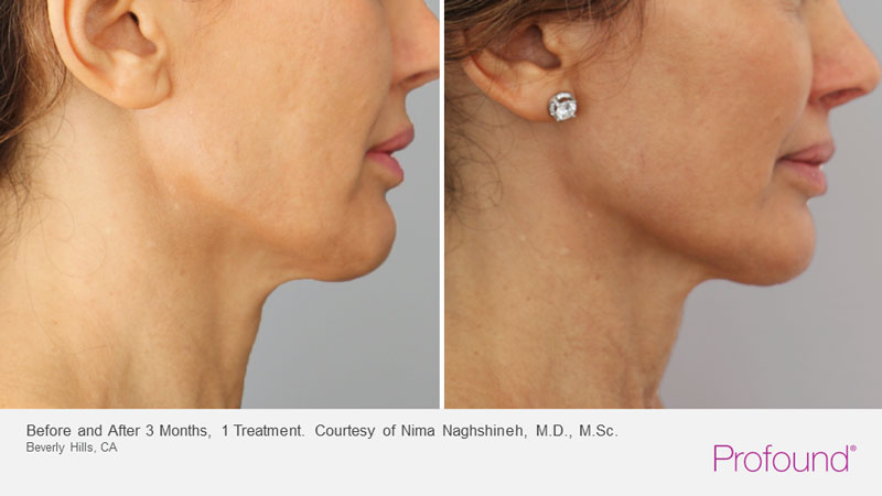 Profound Facial Treatment Before & After Arlington, DC Metro